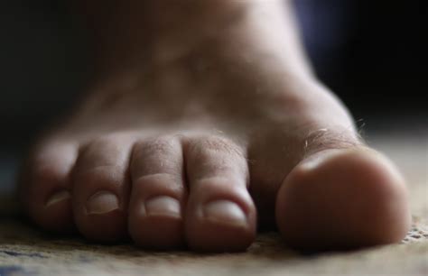 Bunionettes Tailor S Bunion Hurst Podiatry