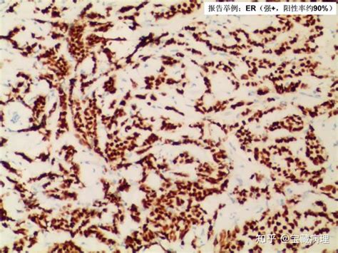 病理规培：一文掌握乳腺癌er、pr免疫组化判读 知乎