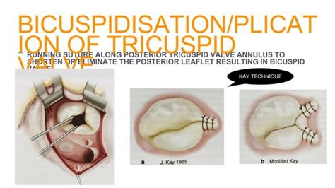 Tricuspid Valve Disease Ppt