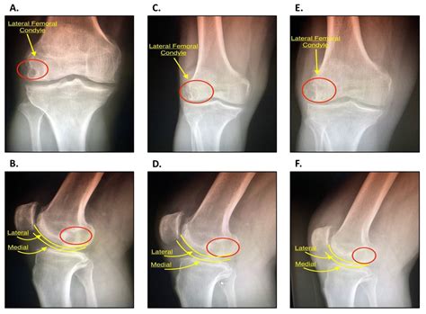 Medial Femoral Condyle Fracture