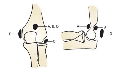 Accessory Bones Of The Elbow Wikism Sports Medicine Wiki