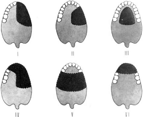 Maxillectomy Semantic Scholar