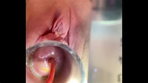 W 4cc Inflation Of Catheter Balloon Inside Cervix Xxx Mobile Porno Videos And Movies Iporntv Net