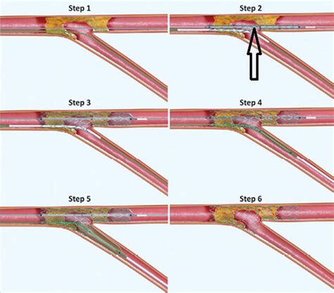 Dedicated Bifurcation Stents Intechopen