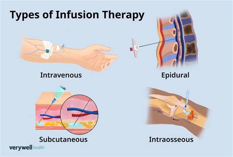 Medical Infusion Therapy Uses Benefits And Side Effects