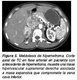 MASAS SUPRARRENALES EVALUACIÓN POR TOMOGRAFIA COMPUTADA Y RESONANCIA MAGNÉTICA