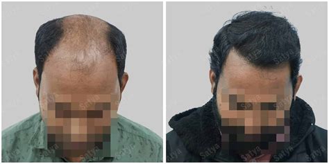 Elon Musk Hair Transplant Lessons Learnt