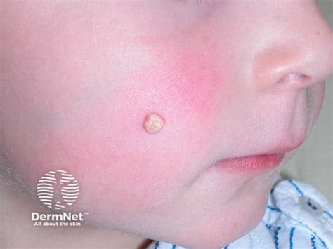 Calcinosis Cutis Images