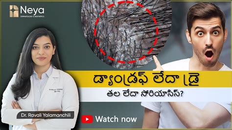 Scalp Psoriasis Vs Dandruff Vs Dry Scalp Dandruff Treatment In Telugu