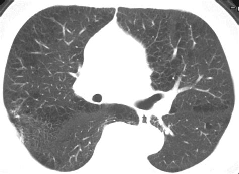 Usual Interstitial Pneumonia And Nonspecific Interstitial Pneumonia