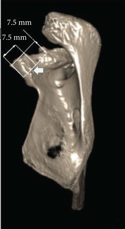 Ct Scan Showing The Coracoid Process Remnants Measure A Scapula