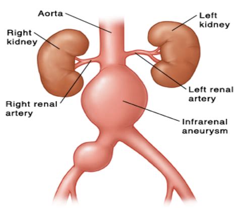 Emergency Medicine Educationabdominal Aortic Aneurysm