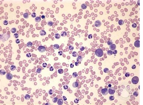 Leukemia Flashcards Quizlet