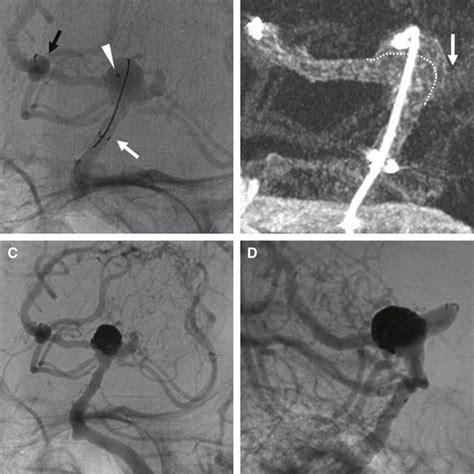 Pdf Intentional Stent Herniation Technique Using Neuroform Atlas Stent System For Embolization