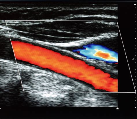 92 Color Doppler Flow Imaging Human Royalty Free Photos And Stock