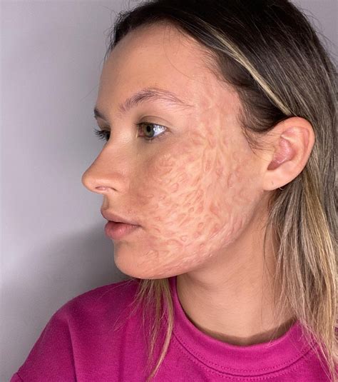 Old Burn Scar Silicone Prosthetic Etsy Uk