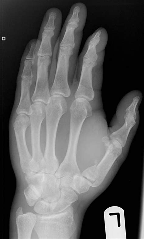 Finger Fracture Detection Object Detection Dataset By Yololo