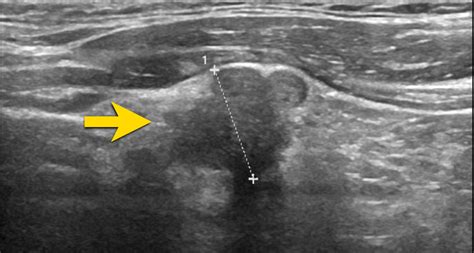 The Radiology Assistant Ti Rads Thyroid Imaging Reporting And Data System