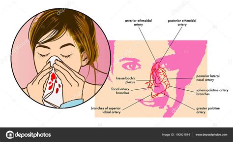 Cartel Médico Epistaxis Ilustración Vectorial Vector Gráfico Vectorial