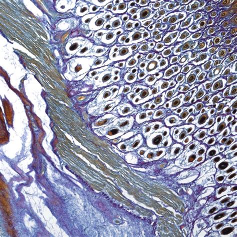 Miocarditis Bacteriana Enfermedad Cardíaca Inflamatoria Histopatología Imagen De Archivo