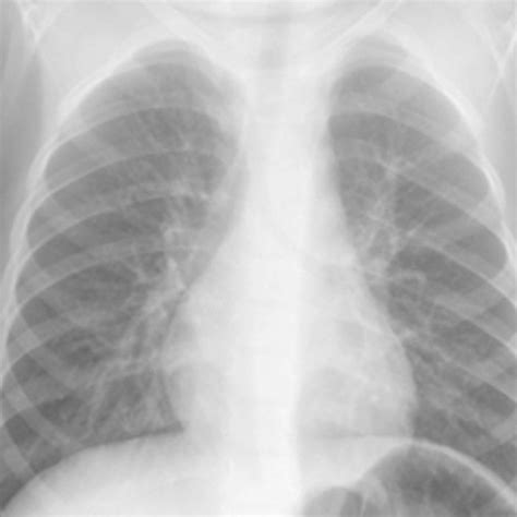 Procalcitonin Testing For Pediatric Pneumonia Diagnosis Point Of Care Insights