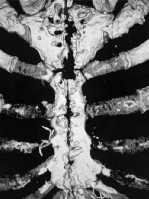 A Ct Scan Of The Sternum With 3d Reconstruction Showing The Download Scientific Diagram