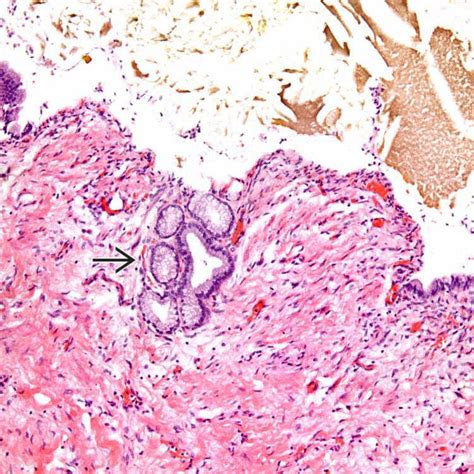 Inflammatory Polyps Basicmedical Key