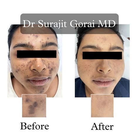 Dark Spots Or Dr Surajit Gorai Md Dermatology