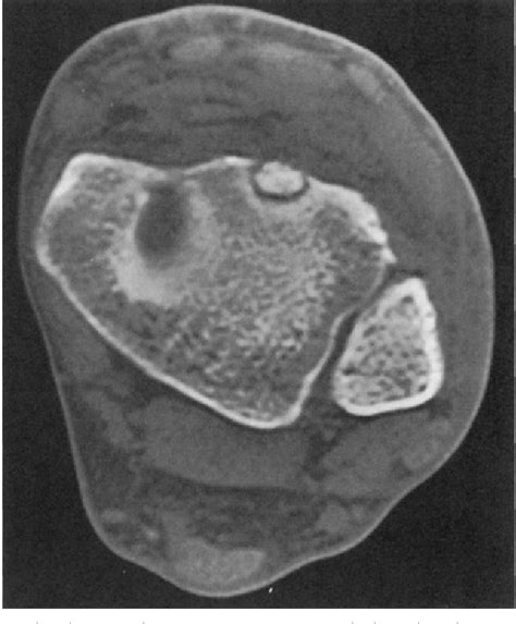 Figure 1 From Intra Articular Osteoid Osteoma As A Cause Of Chronic
