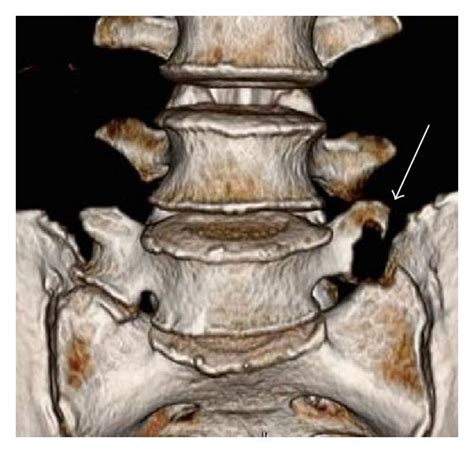 Treatment Options For Partial Sacralisation Or Bertolottis Syndrome
