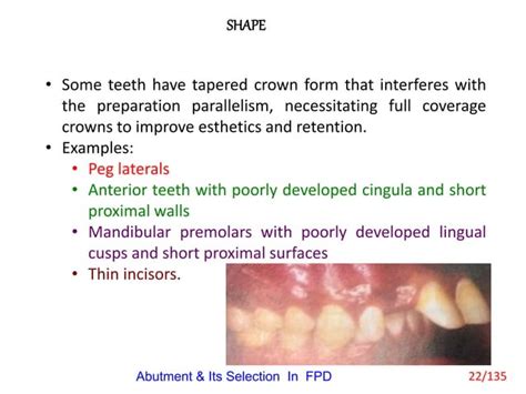Abutment And Its Selection In Fixed Partial Denture Pptx
