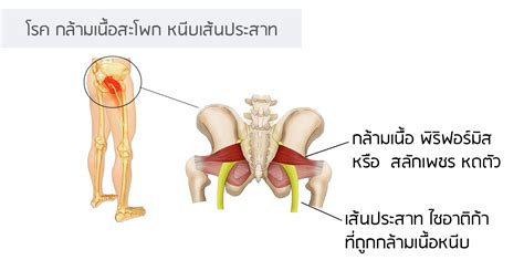 Ep65 ปวดก้น ร้าวลงขา โรคกล้ามเนื้อสะโพกหนีบเส้นประสาท