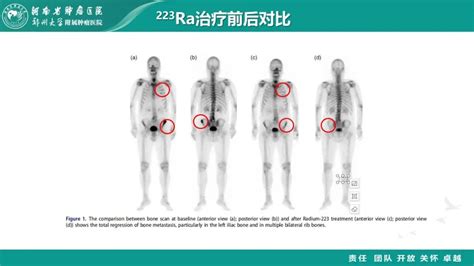 中华医学会核医学分会 核汇园 【核汇园】之（78）：杨辉教授讲授《基于前列腺癌诊治的核医学方案》