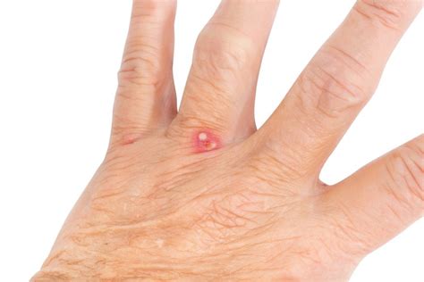 How To Treat Common Stings