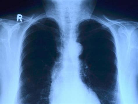 Tipos De Radiografia De Torax