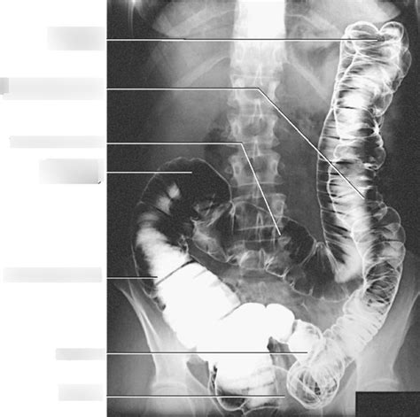 Ap Projection Double Contrast Barium Enema Diagram Quizlet
