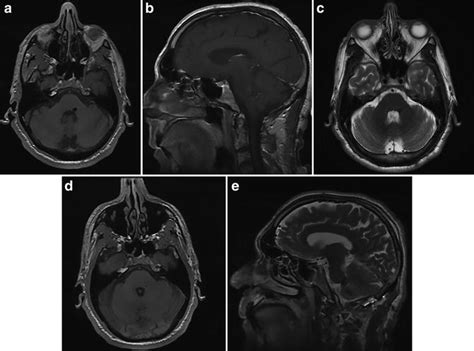 Microsurgical Management Of Posterior Fossa Vascular Lesions Neupsy Key