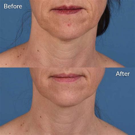 Skinpen Prf Microneedling Scottsdale Get Younger Looking Skin Naturally