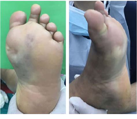 Figure 1 From Jahss Type One Posterior First Metatarsophalangeal