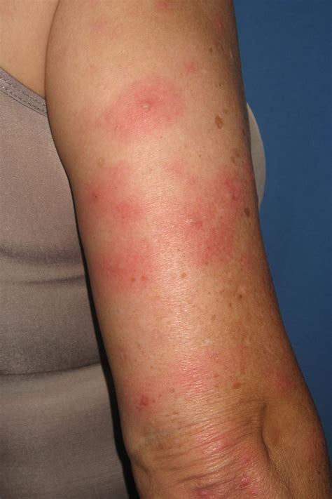 Ulcerative Colitis Rash Signs And Symptoms