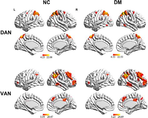The Typical Anatomical Pattern Of The Dorsal Attention Network Dan