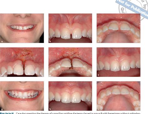 Figure 5 From Does The Maxillary Midline Diastema Close After