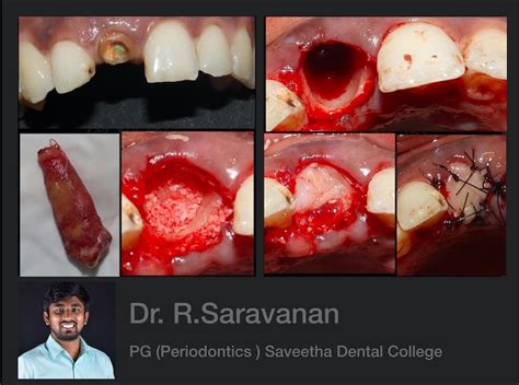 Socket Preservation Using Xenograft And Prf — Periodontics Saveetha