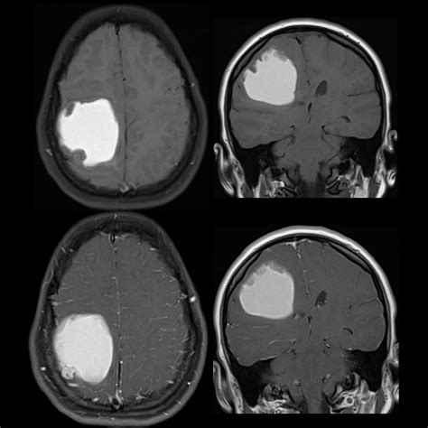 Pediatric Supratentorial Ependymoma Pediatric Radiology Reference