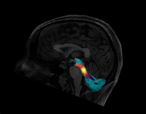 Putting Mrtrix Tractography Into PyAFQ Python Neurostars