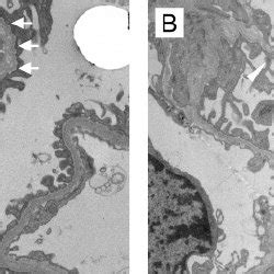Electron Micrography Findings Of The Kidney Biopsy Specimen A