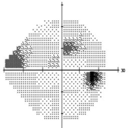 Which Is And Nasal Visual Field Interpretation