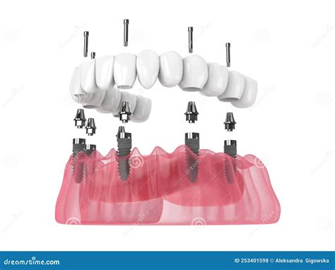 3d Render Of Mandibular Prosthesis All On 6 System Supported By Implants Stock Illustration