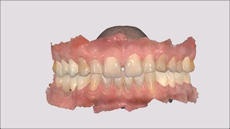 Injectable Composite Conservative Predictable Aesthetic And