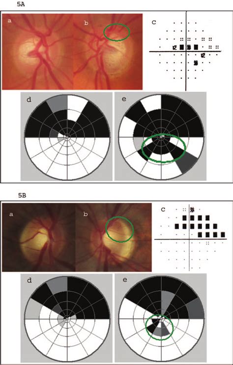 Examples Of Second Abnormal Hemifield Detected By Dichoptic Mfvep A Download Scientific